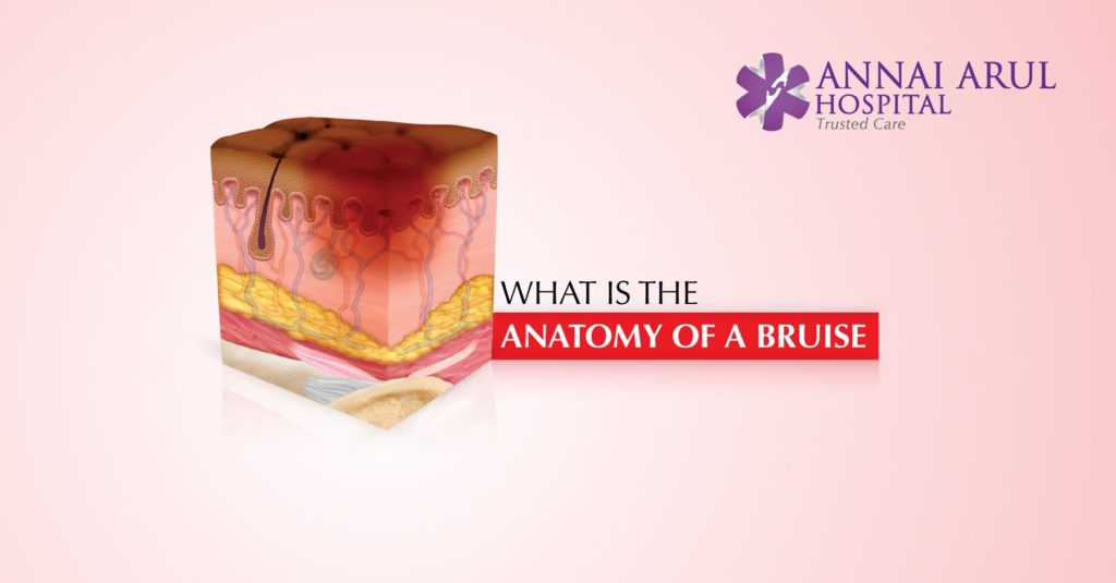 WHAT IS THE ANATOMY OF A BRUISE? – Multispeciality Hospitals in Chennai