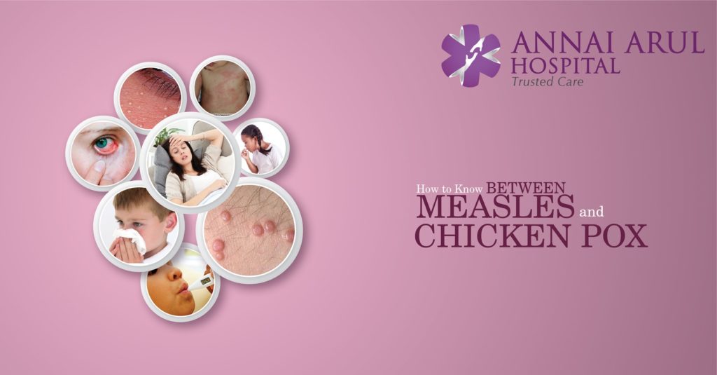 HOW TO KNOW BETWEEN MEASLES AND CHICKEN POX? – Multispeciality ...
